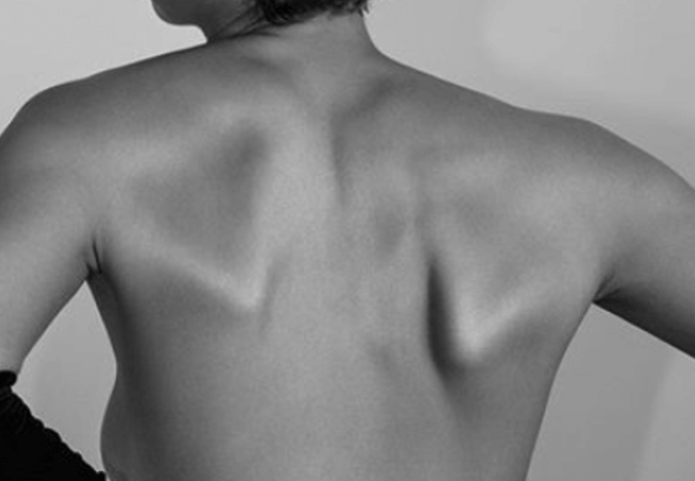 Shoulder bony landmarks | Anatomy For Sculptors
